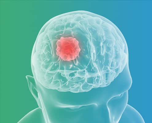 Cáncer cerebral y tumor de médula espinal - Centro 360 de Excelencia ...